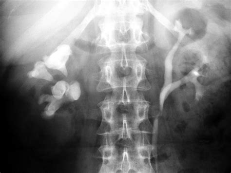 Pyelonephritis X Ray