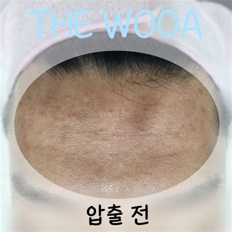 마산피부관리 전문 더우아 에스테틱 여드름관리 후기 네이버 블로그