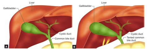 S 23a And B Testing Of Common Bile Duct
