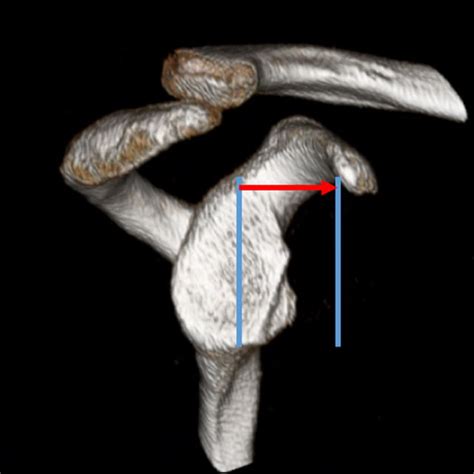 Typical Coracoid Morphology Associated With Inferior Glenoid Lesions A