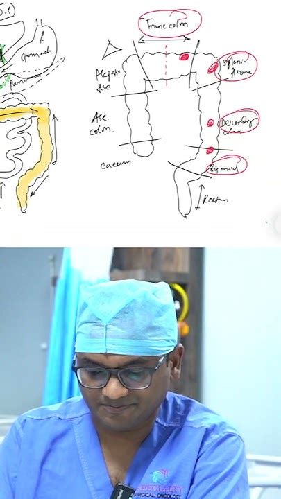 Step By Step Left Hemicolectomy Understanding Colon Cancer Treatment