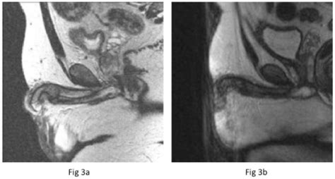 Mri Scans A Pre Chemotherapy T2 Sagittal Thin Penile Mri Slices