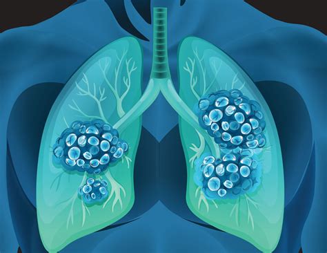 Deep Learning Model Developed To Identify Appropriate Lung Cancer Therapy