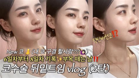 성형브이로그 Ep2 New 코 구경 할 사람🫣부끄🥹드디어 부목 떼는 날‼️ 끝나지 않은 붓기와의 전쟁🔥 코수술 Vlog🤥 수술 후 관리법 코수술 👃