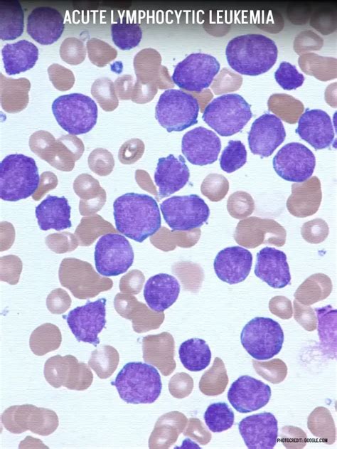 Acute Lymphocytic Leukemia Explained Symptoms Diagnosis And Treatment