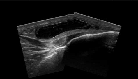 슬개골 아래가 아파요 슬개하점액낭염infrapatellar Bursitis Clergymans Knee 청담동한의원