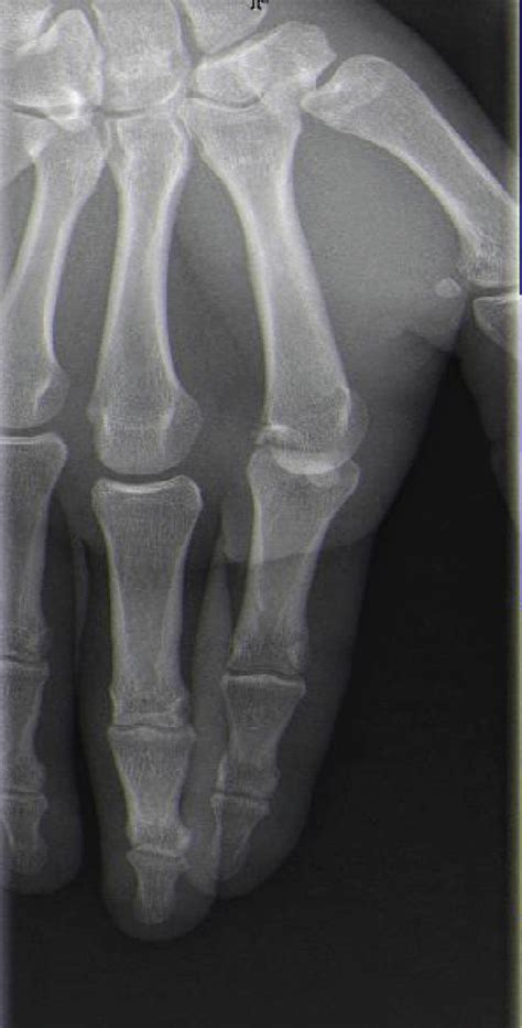 X Ray Ap View Showing Mcp Dislocation Of The Index Finger Download