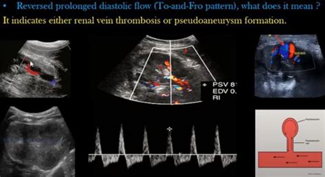 Reversed Prolonged Diastolic Flow To And Fro Pattern Pseudoaneurysm Is Associated With