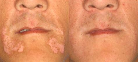 Patient 16 Before Using Blue Led Light Vasi Score 3375 And 3 Months Download Scientific