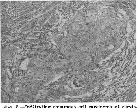 Simultaneous Adenocarcinoma Of The Endometrium With Squamous Cell Carcinoma Of The Cervix Uteri