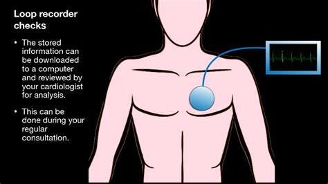 Implantable Loop Recorder ILR Associate Professor Sandeep Prabhu
