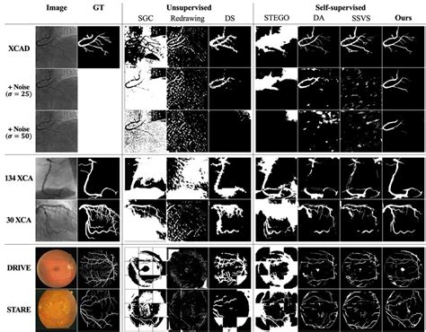 Visual Comparison Results On The Vessel Segmentation Of Various Download Scientific Diagram