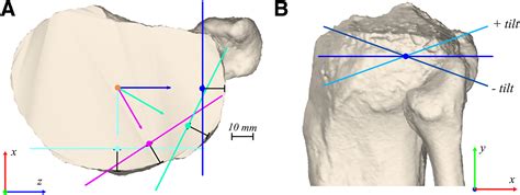 Three Dimensional Hinge Axis Orientation Contributes To Simultaneous Alignment Correction In All
