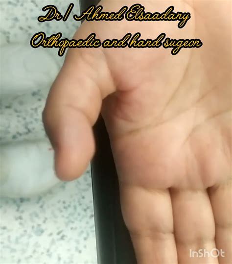 Trigger Thumb تسليك وتر الإبهام Youtube