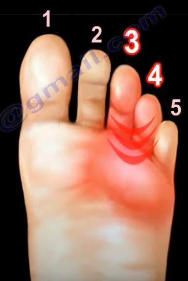 발바닥 통증 이중에 하나일겁니다 통풍 무지외반증 지간신경종 족저근막염 아킬레스건염 네이버 블로그