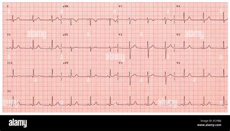 Normal Ecg Hi Res Stock Photography And Images Alamy