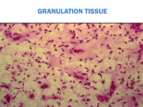 Ppt Inflammation And Repair Powerpoint Presentation Free Download