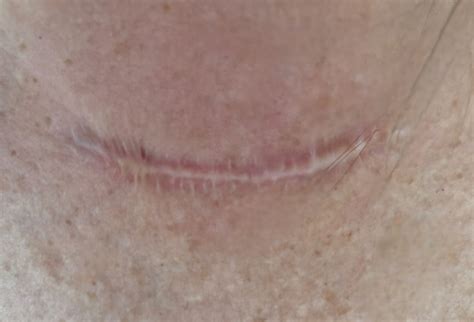 What Is An Abnormal Scar — Serge Zogheib Md