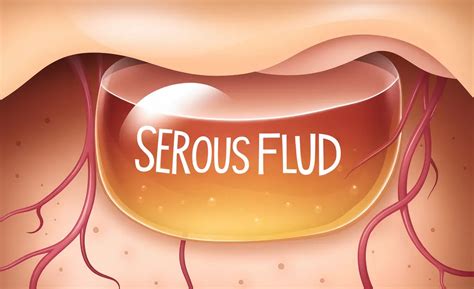 Understanding Seromas Causes Symptoms And Treatments