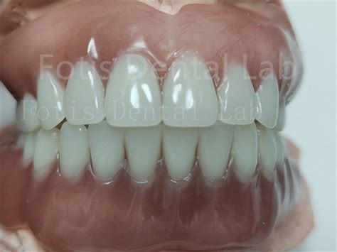 Comfortable Full Upper Acrylic Denture Complete Acrylic Denture With
