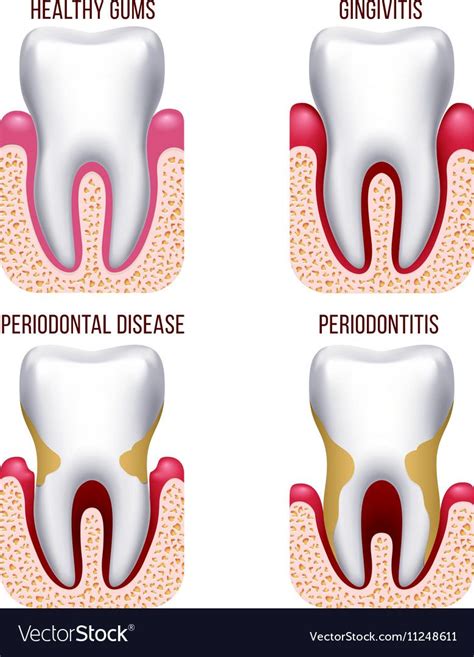 How To Control Bleeding After Tooth Extraction Dunya Led