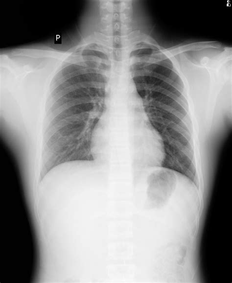 Cxr Object Detection Dataset By Cbc