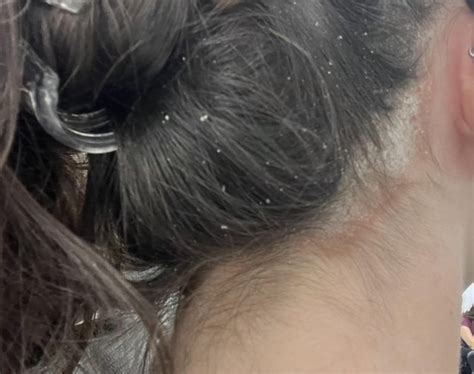 Treatment R Psoriasis