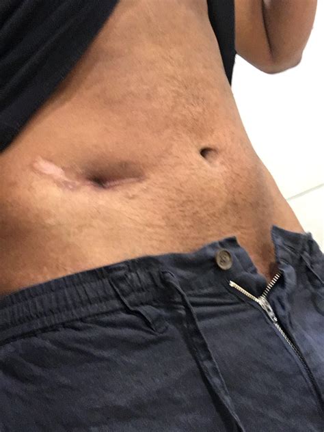Open Appendectomy Scar Any Advice For Surgery Scar