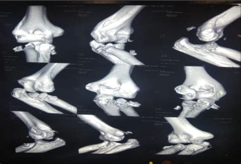 3d Ct Of Right Elbow Download Scientific Diagram