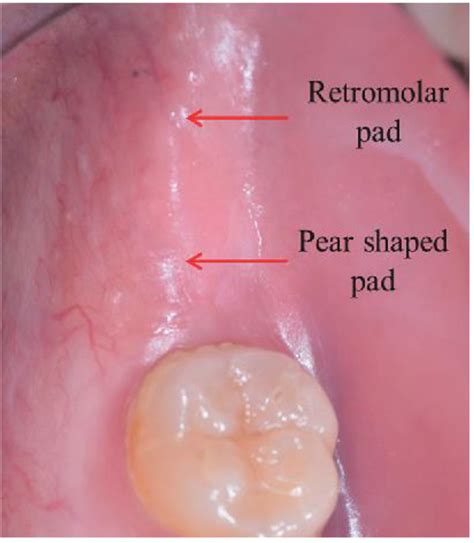 Where Is The Retromolar Pad Located At Deloris Colvin Blog