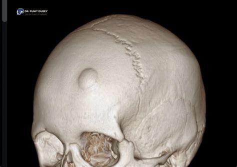 Osteoma Forehead Treatment In Delhi