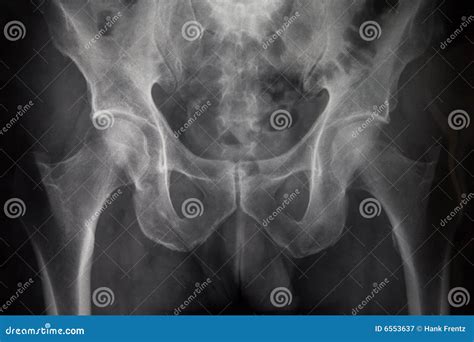 Pelvic X Ray Stock Image Image Of Back Medicine Skeleton 6553637