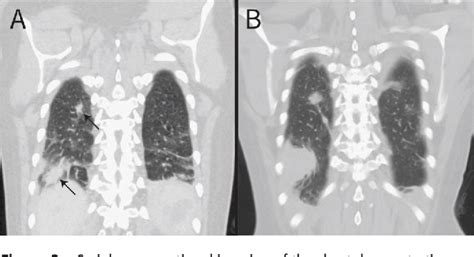 Figure 2 From Aseptic Abscess Syndrome Semantic Scholar