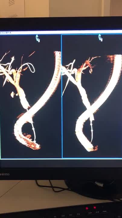 Ivo Boskoski On Linkedin The First 3d Ercp Done With The New Artis