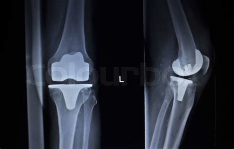 X Ray Orthopedics Scan Of Knee Meniscus Implant Prosthetics Stock