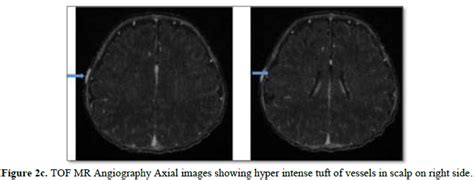 Scitech Management Challenges In Rare Congenital Scalp Arteriovenous Malformation A Case