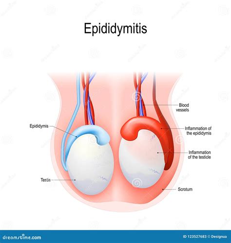 Epididymitis Is Inflammation Of The Epididymis Of The Testicle Stock