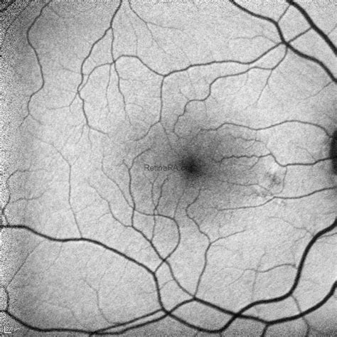 Classical Macular Hole Surgery Retinara