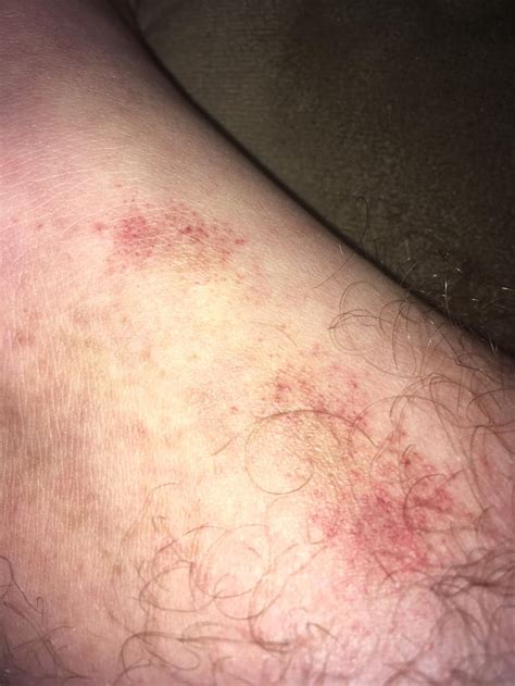 What Is This Rash On My Ankle I Have Had This Rash On My Ankle For