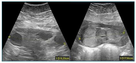 Diagnosis And Management Of Hyperreactio Luteinalis A Rare Condition In Pregnancy