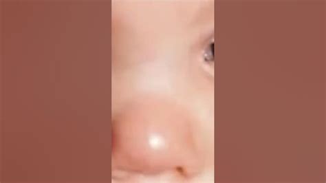 مرض الجلوكوما Youtube