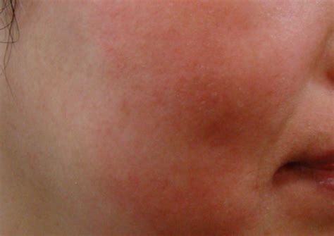 모세혈관확장증 원인과 치료 과정에 대해 안면홍조 주사비 네이버 블로그