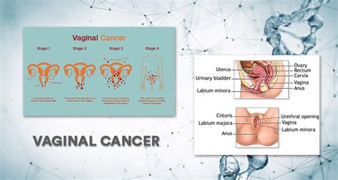 Vaginal Cancer Treatment