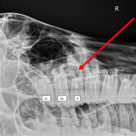 Tooth Abscess Xray