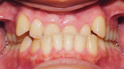 Class Iii Malocclusion Excessive Overbite Excessive Underbite Retroclined Upper Incisors