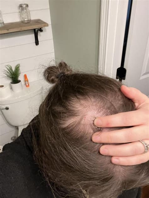 Red Raid Lump On Scalp R Dermatologyquestions