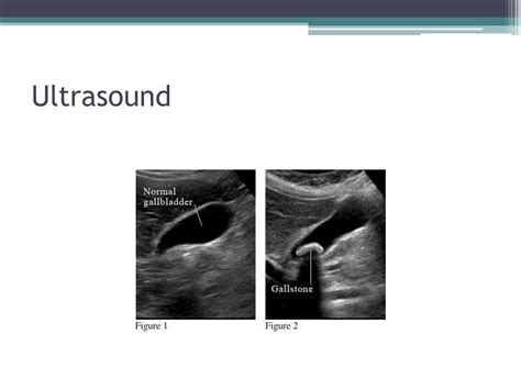 PPT Imaging The Bilary Tree PowerPoint Presentation Free Download ID 3550048 PPT Imaging The Bilary Tree PowerPoint Presentation Free Download ID 3550048
