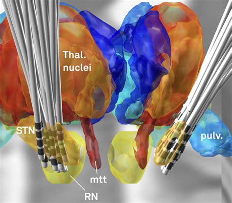 Subcortical Electrophysiology Mapping Lead Dbs