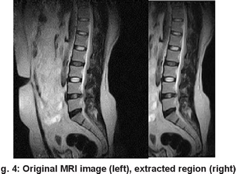 Figure 1 From Classification Of Lumber Spine Disc Herniation Using Machine Learning Methods