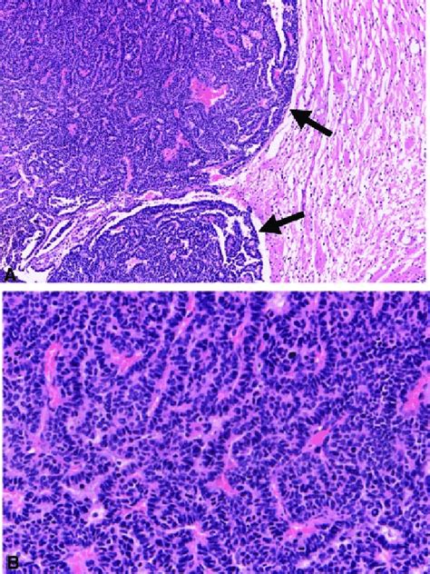 Histopathology Of GEM Choroid Plexus Tumors A Low Power Shows Tumor Download Scientific